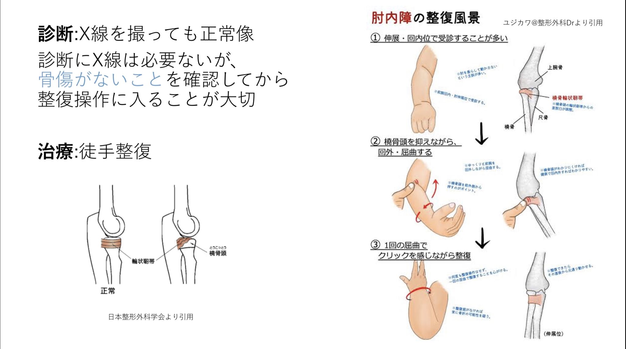 【小児の骨折】小児の外傷（整形外科疾患）を研修医、看護師さん向けに勉強会スライドをまとめました。 - Dr.maple blog
